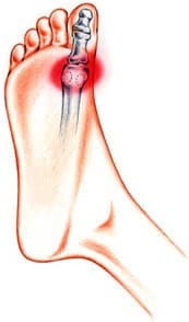 Blessure de Foot - Le Sesamoide - Foot-Entrainements